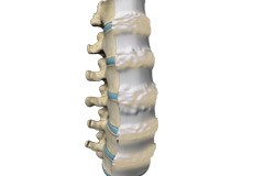 Diffuse Idiopathic Skeletal Hyperostosis (DISH) Nashville | Myelopathy ...