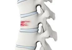 Spinal Fractures Murfreesboro | Vertebral Compression Fractures ...